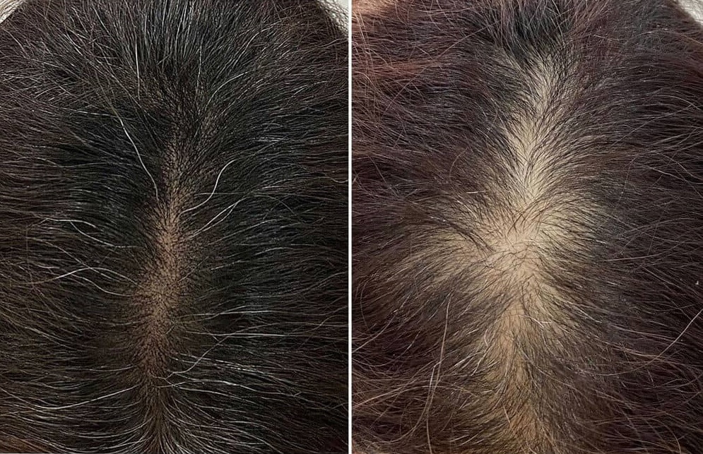 Everything You Need to Know About Hairline Tattoos: A Comprehensive ...