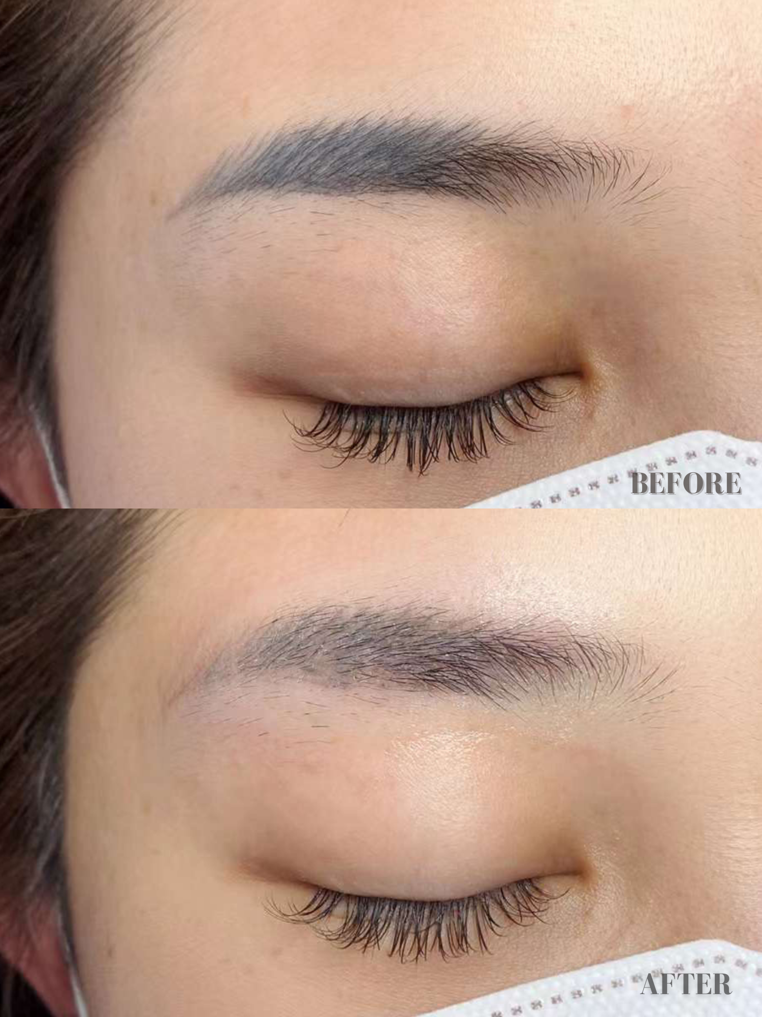 Comprehensive Guide to Phi Removal: Techniques, Processes, and ...