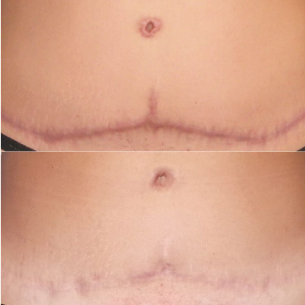 Reclaim Your Skin: The Ultimate Guide to Scar Camouflage Tattoos ...